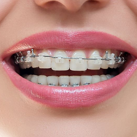 ORTODONTIA-AUTOLIGADO-ESTETICO - Sorrix